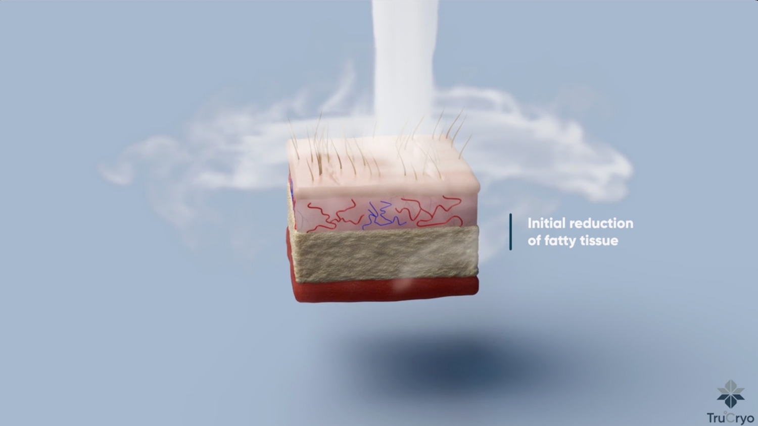 Cryo-Sculpting | Cryo Reload, LLC | Brownsville, TX.